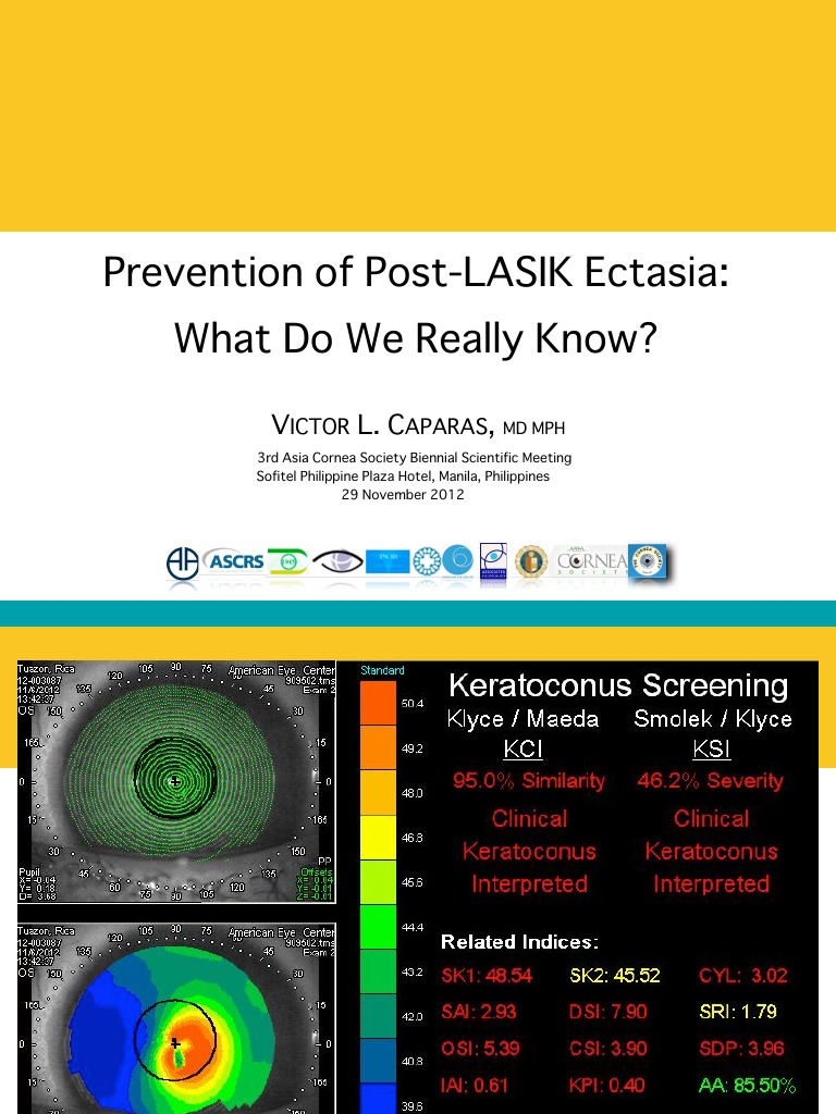 Post LASIK Ectasia | Cornea | Ophthalmology