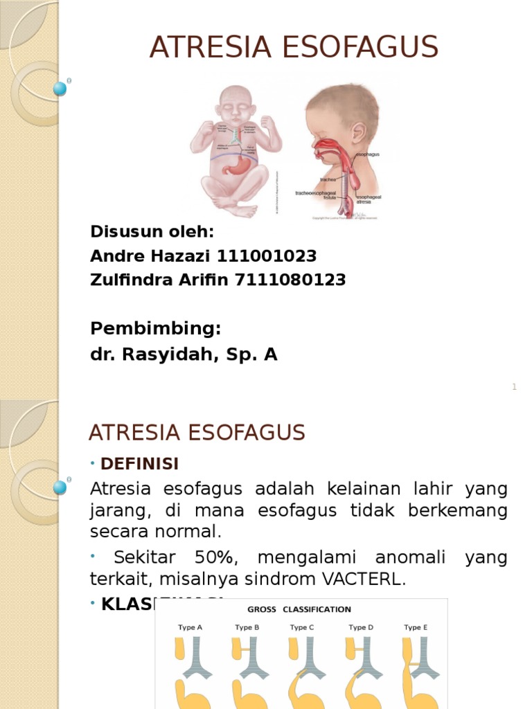 Atresia Esofagus | PDF