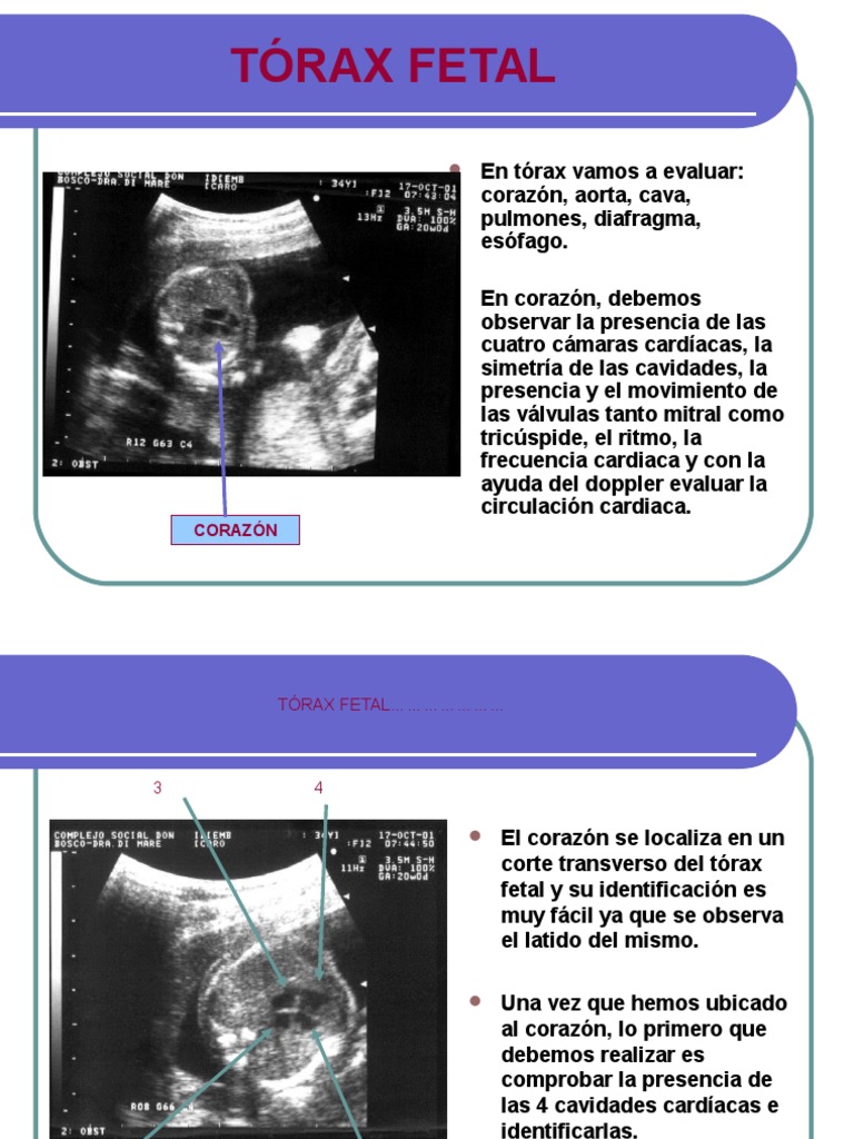 Evaluación del Tórax Fetal en Ecografía | PDF | Tórax | Corazón