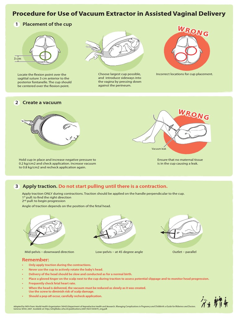 Vacuum Extractor Delivery Procedure Guide | PDF | Wellness