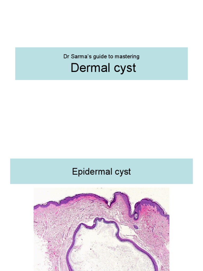 Guide to Dermal Cysts Explained | PDF