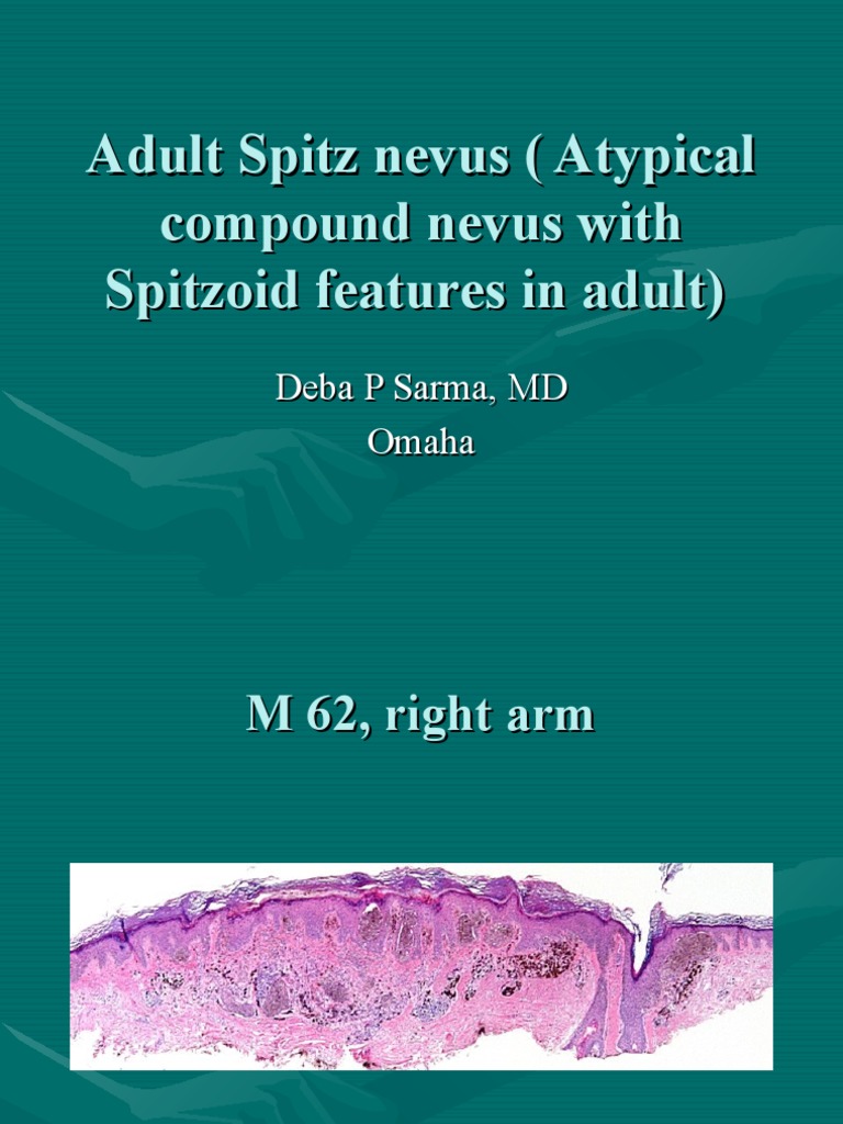 Adult Spitz Nevus (Atypical Compound Nevus With Spitzoid Features in ...