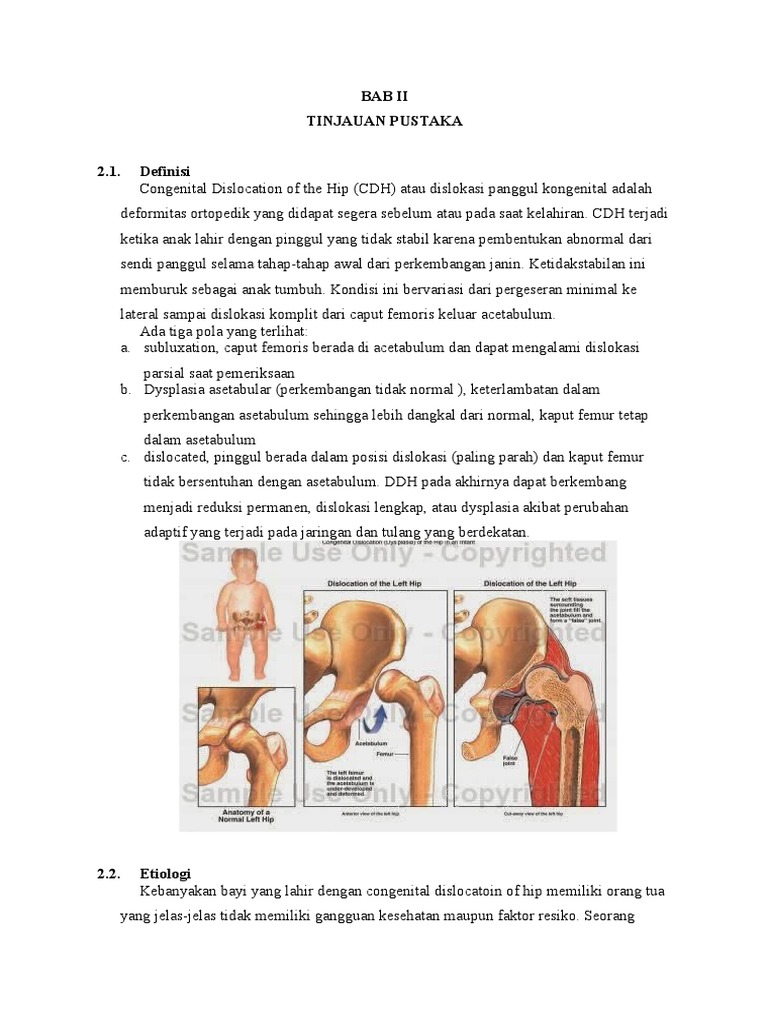 CDH (Congenital Dislocation of Hip) | PDF