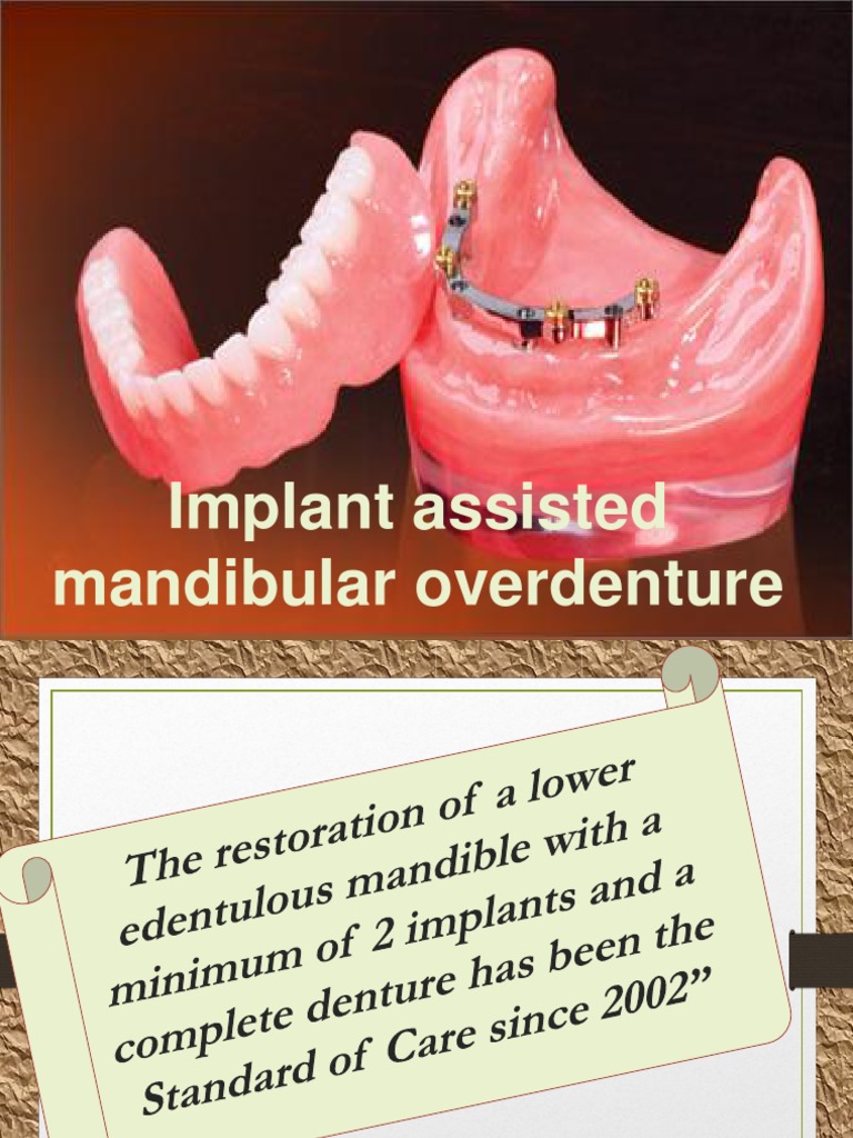 Mandibular Overdenture PDF | PDF | Dental Implant | Dentures