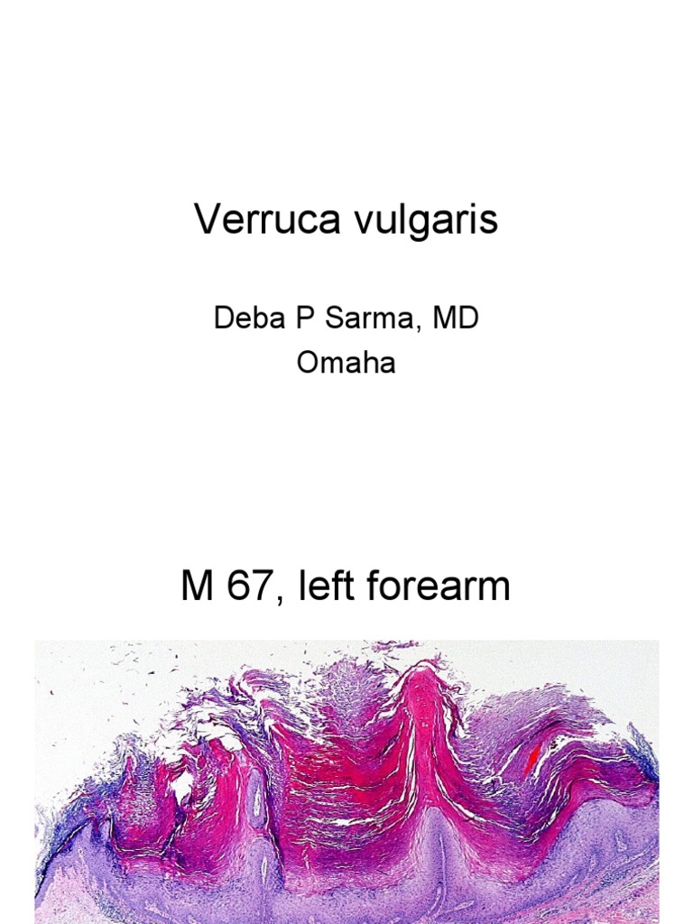 Verruca Vulgaris | PDF