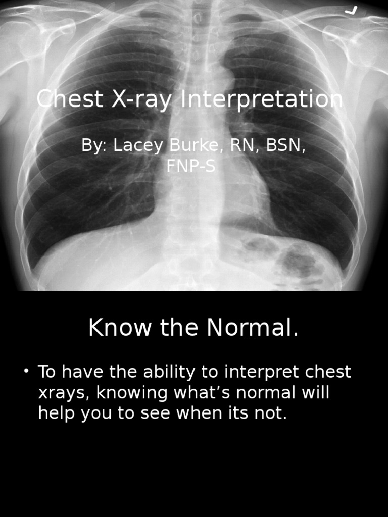 Chest Xray Interpretation | PDF | Lung | Atrium (Heart)