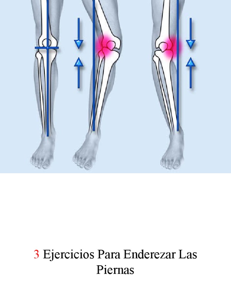 Piernas Arqueadas Tratamiento, Como Corregir Las Piernas Chuecas ...