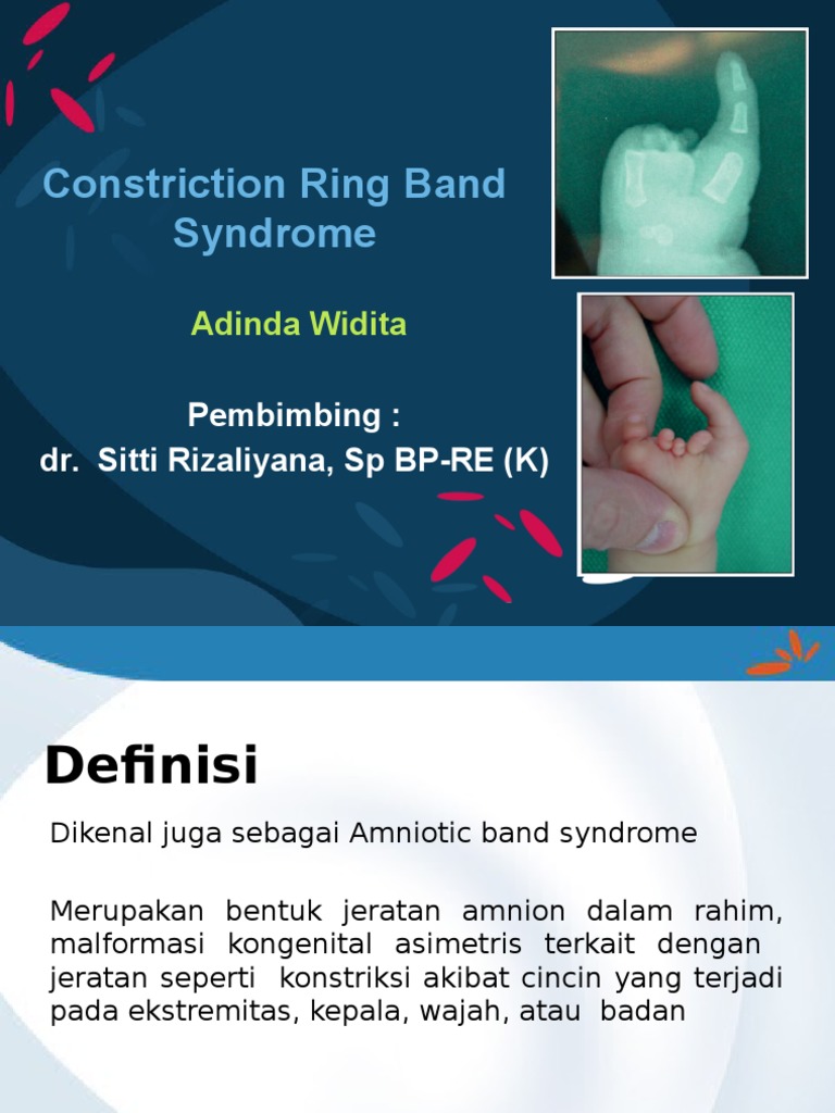 Constriction Band Syndrome ADN | PDF