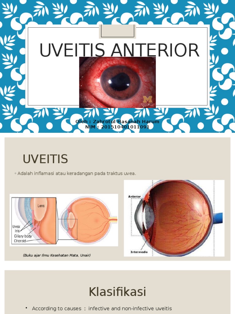 Uveitis Anterior | PDF