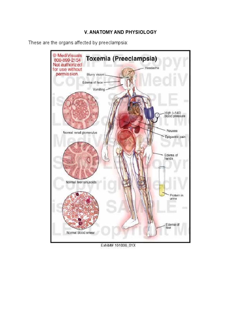 Anatomy Pathophysiology Preeclampsia | PDF | Animal Anatomy | Diseases ...