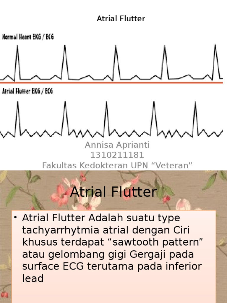 Atrial Flutter | PDF