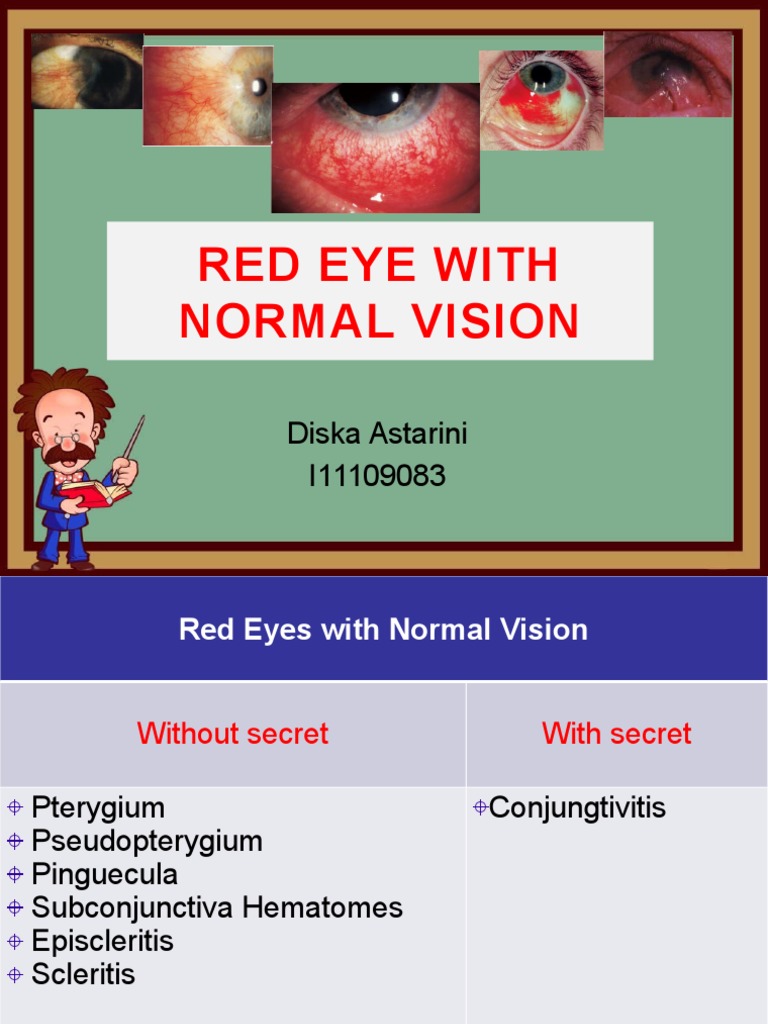 Red Eye With Normal Vision | Download Free PDF | Diseases Of The Eye ...