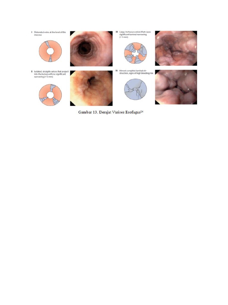 Derajat Varises Esofagus | PDF