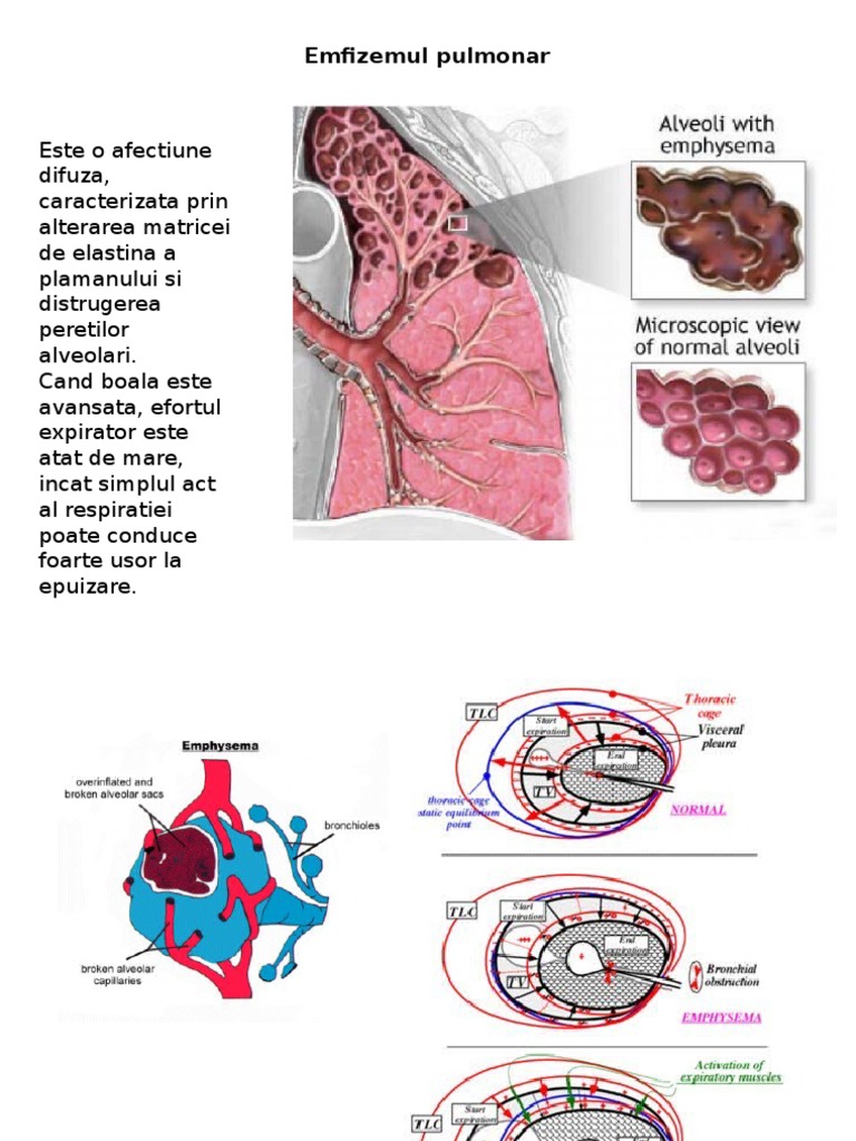 Emfizemul | Lung | Chronic Obstructive Pulmonary Disease