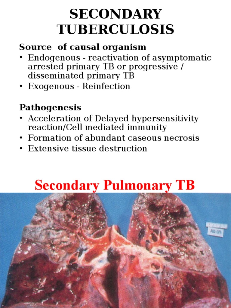 Secondary Tuberculosis | PDF | Tuberculosis | Clinical Medicine