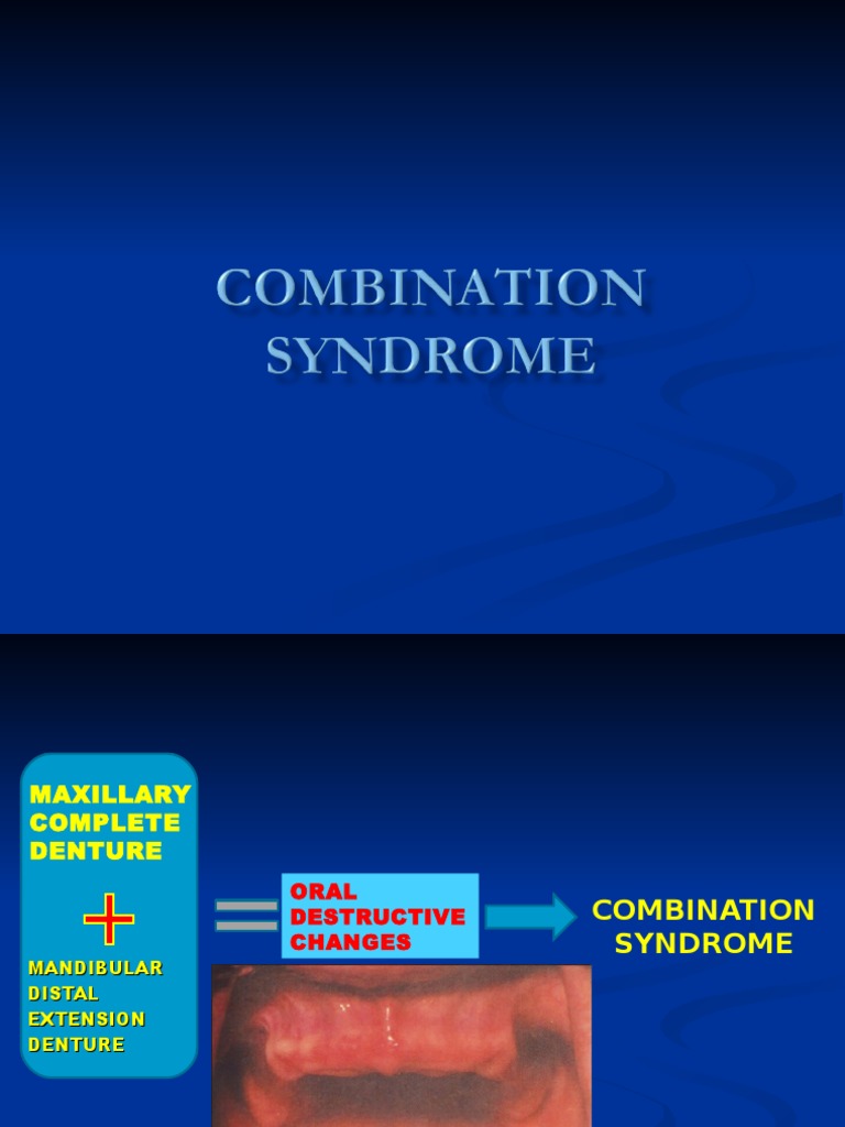 Combinationsyndromerevised 130508055551 Phpapp01 | PDF | Dentures ...