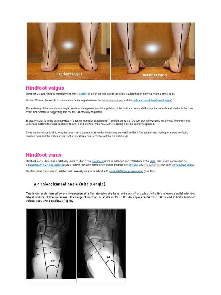Hindfoot Valgus: AP Talocalcaneal Angle (Kite's Angle) | Download Free ...