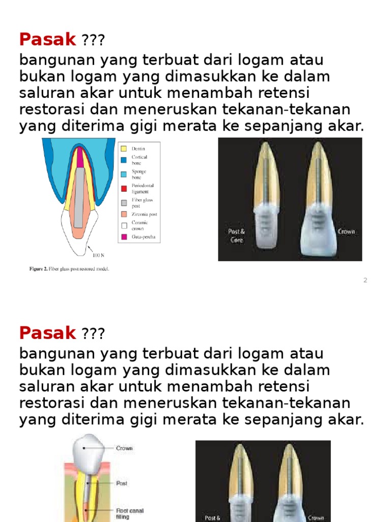 Pasak Dan Inti Pasak Drg. Verawaty SPKG | PDF | Sains & Matematika