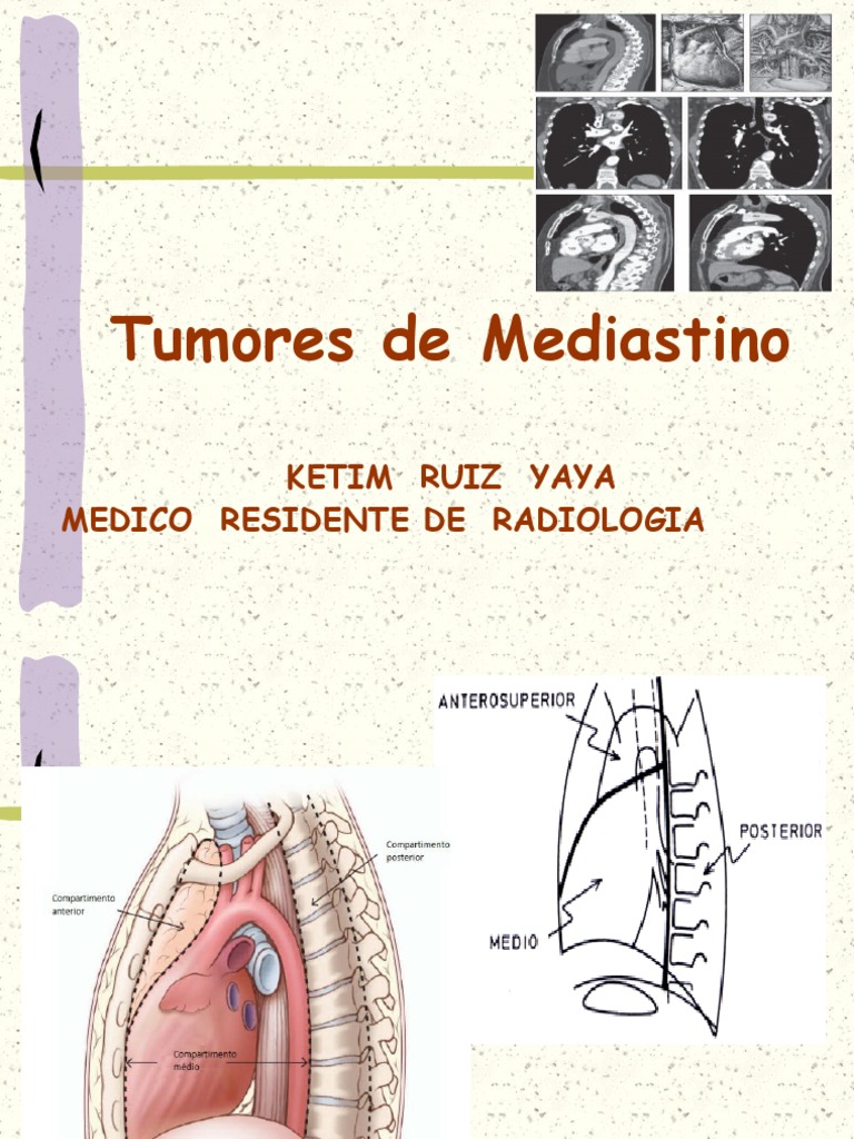 Tumores de Mediastino Nuevo | PDF | Aorta | Tórax (anatomía humana)
