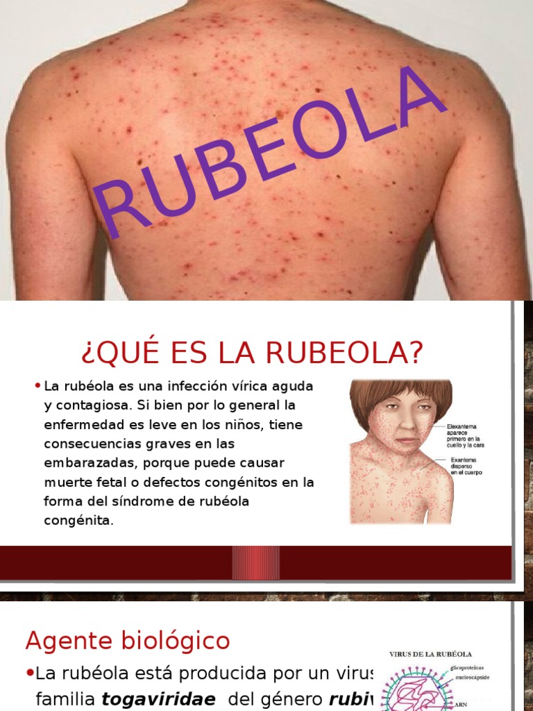 Síntomas y características de la rubeola | PDF
