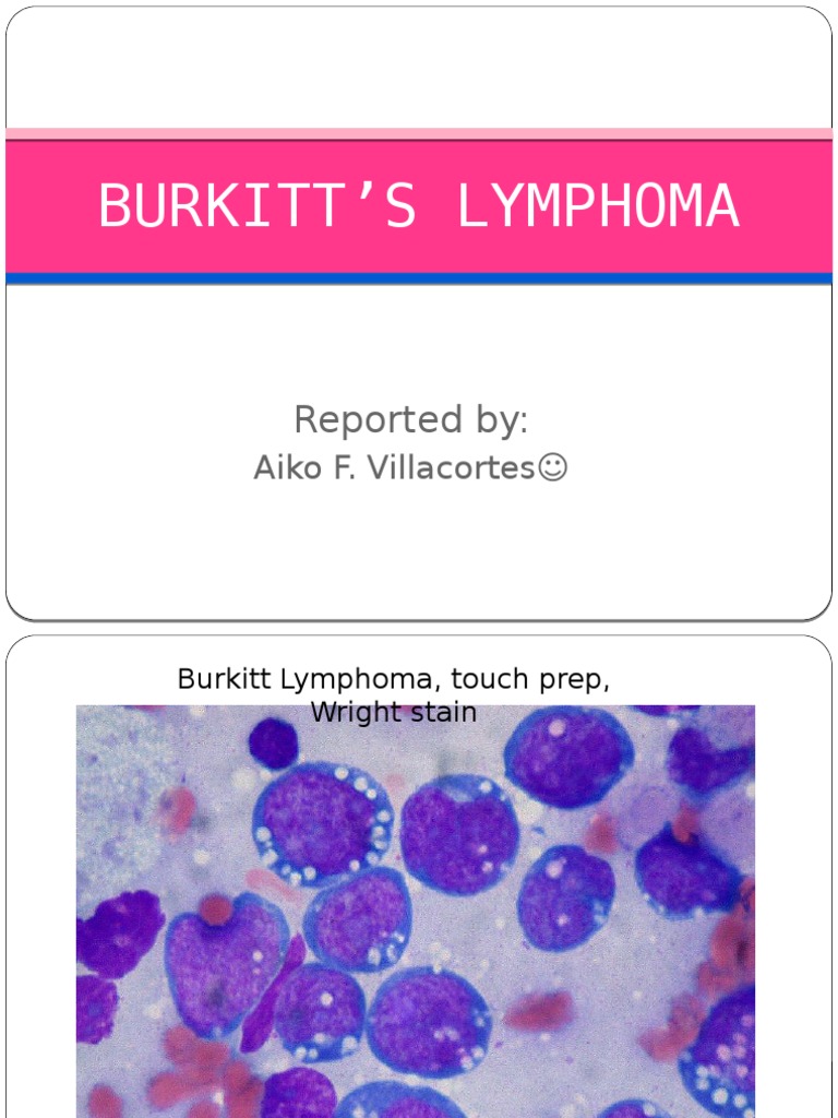 Burkitt S Lymphoma Pdf Lymphoma Lymphatic System
