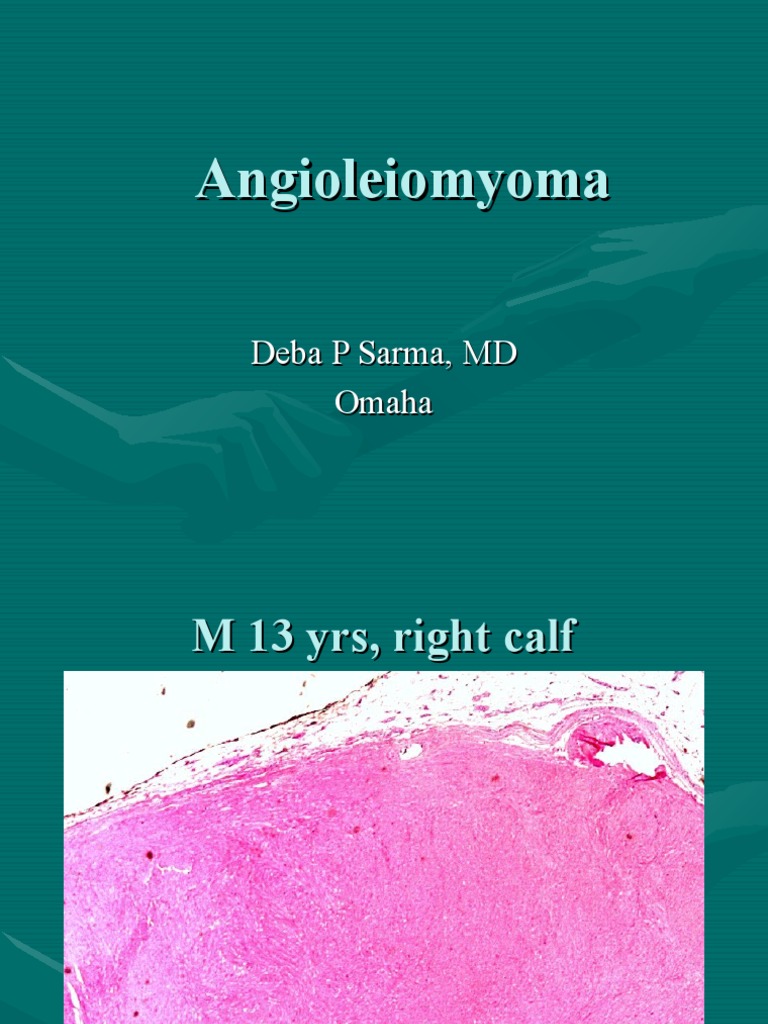 Angioleiomyoma | PDF