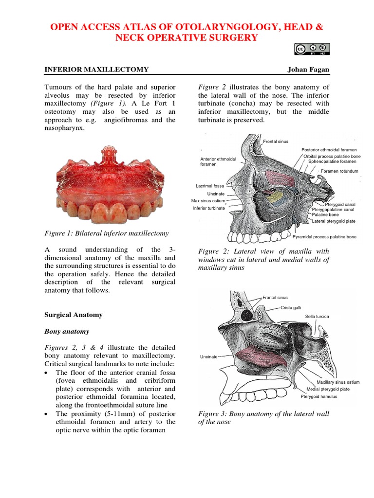 Inferior Maxillectomy | PDF | Skeletal System | Human Head And Neck