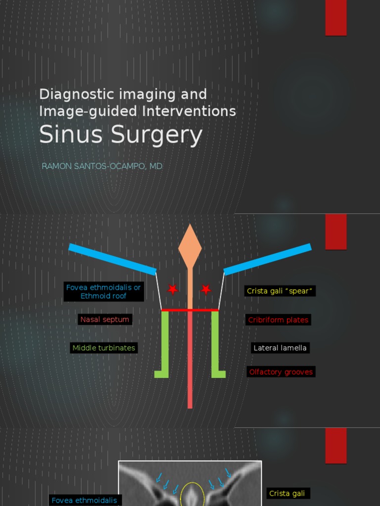 Anatomy of the Paranasal Sinuses: A Comprehensive Guide for Functional ...