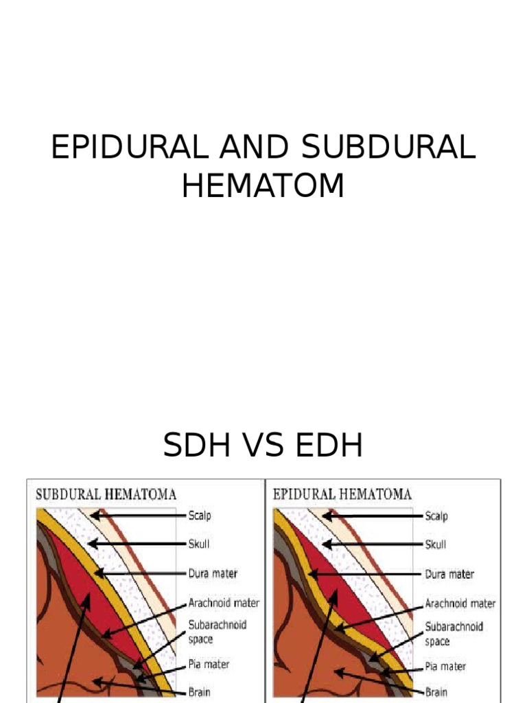 EDH and SDH: Key Differences Explained | PDF