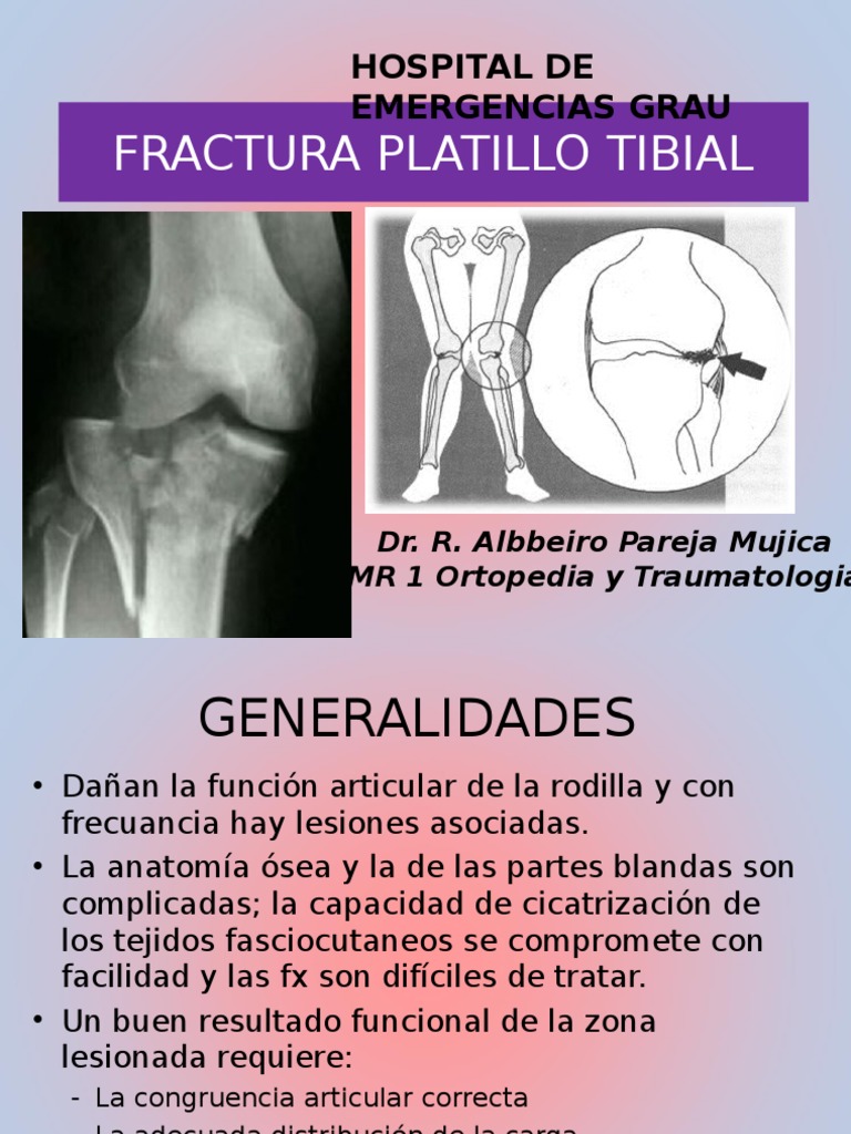 Fracturas Platillo Tibial | Cirugía Ortopédica | Rodilla
