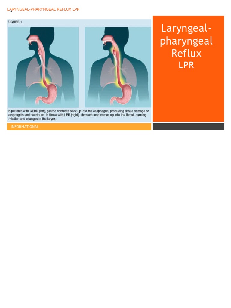 LPR Fact Sheet | PDF | Gastroesophageal Reflux Disease | Heartburn