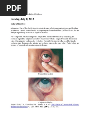 Pallor Conjunctiva