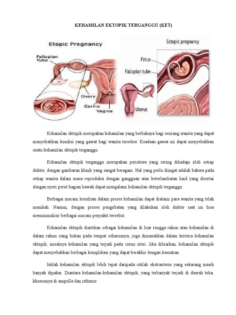 Teori Kehamilan Ektopik Terganggu | PDF