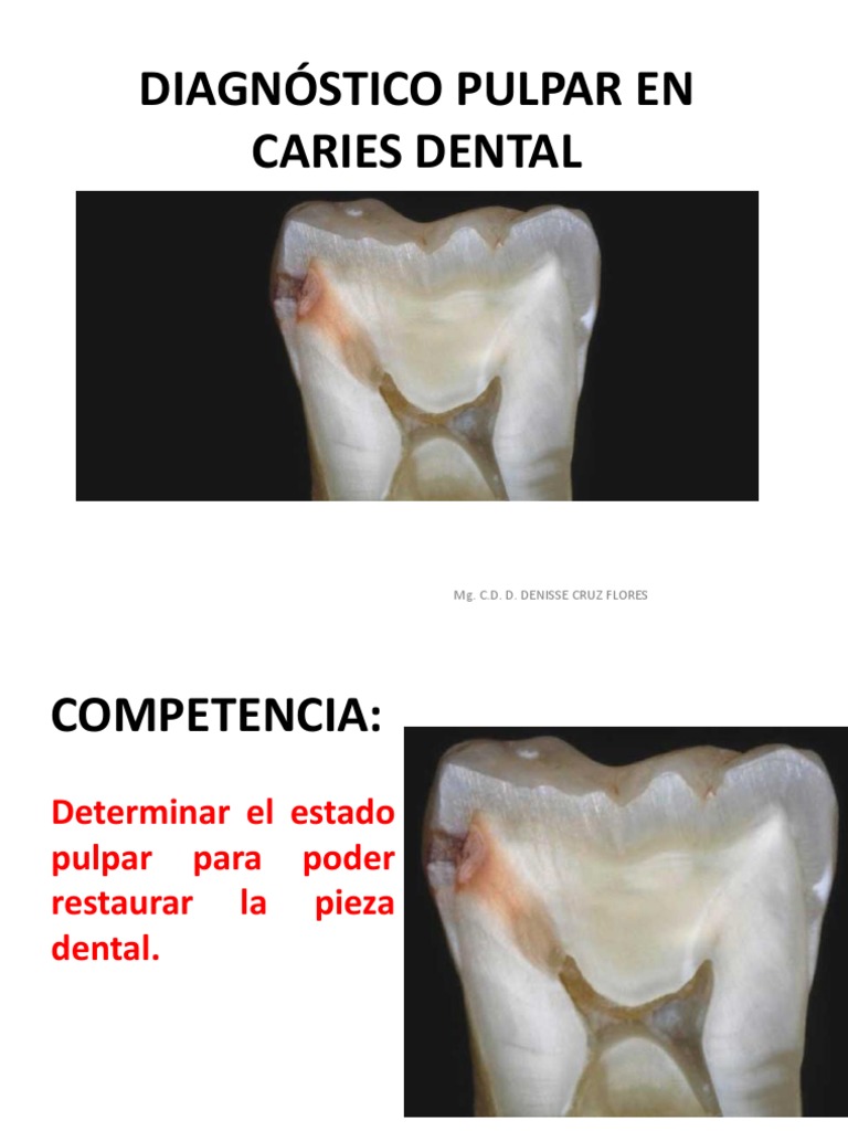 Diagnóstico Pulpar en Caries Dental | PDF | Diente humano | Dolor