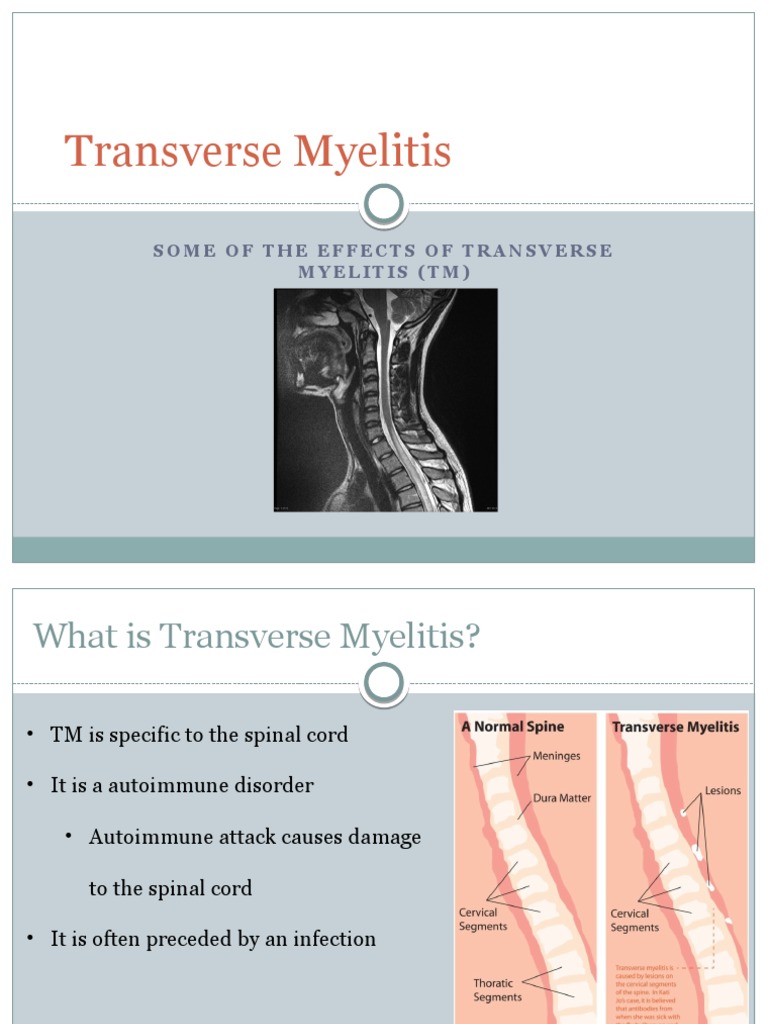 Understanding Transverse Myelitis Effects Pdf Science Mathematics
