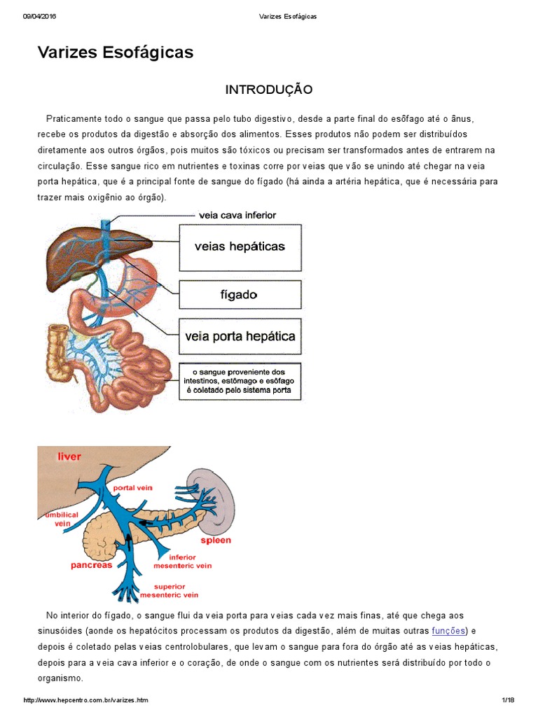 Varizes Esofágicas na Cirrose Hepática: Diagnóstico, Classificação e ...