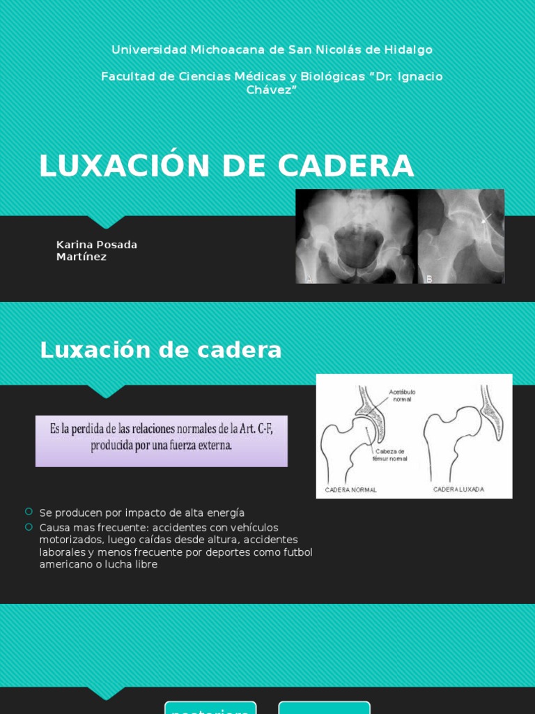 LUXACIÓN DE CADERA 1.ppsx | PDF | Rodilla | Cadera