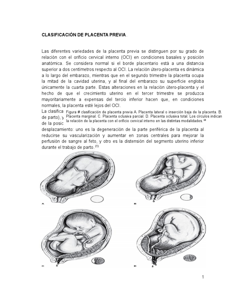 Clasificación de Placenta Previa | Placenta | Parto
