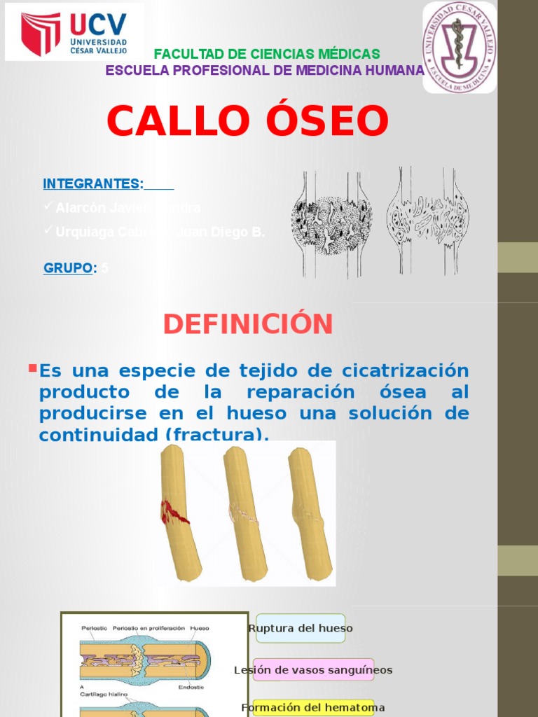 Callo Óseo | PDF | Hueso | Inflamación