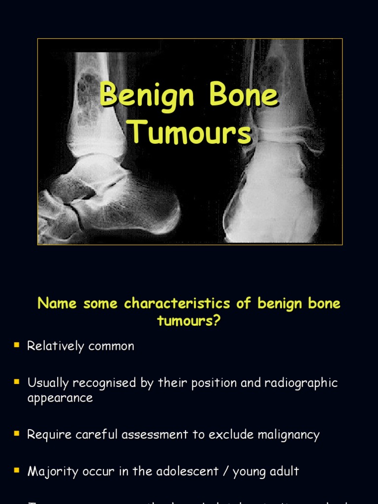 Benign Bone Tumours Lecture (1).ppt | Bone | Neoplasms