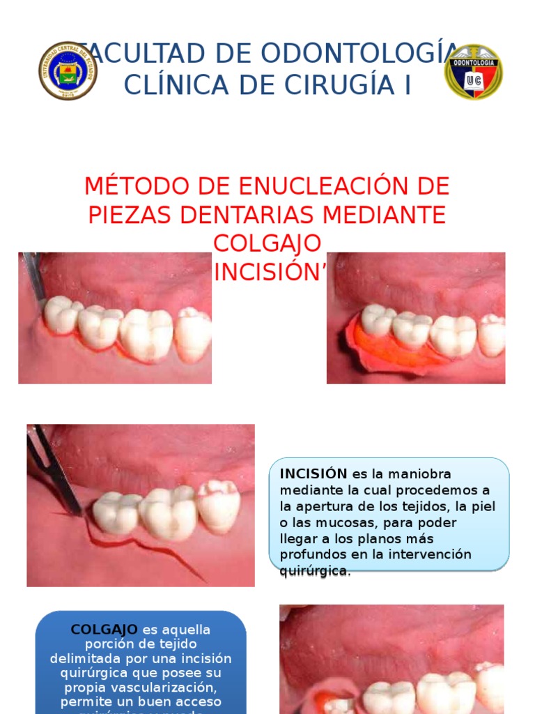 Extraccion Mediante Colgajo Incision | Cirugía | Diente humano