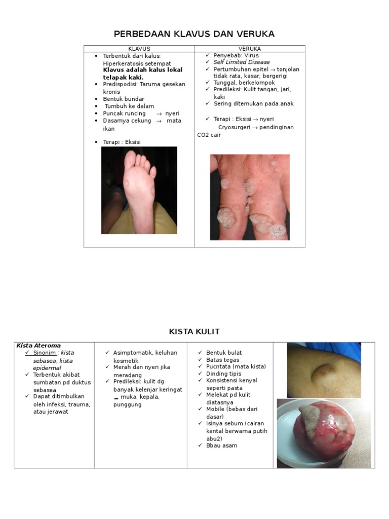 Perbedaan Klavus Dan Veruka | PDF