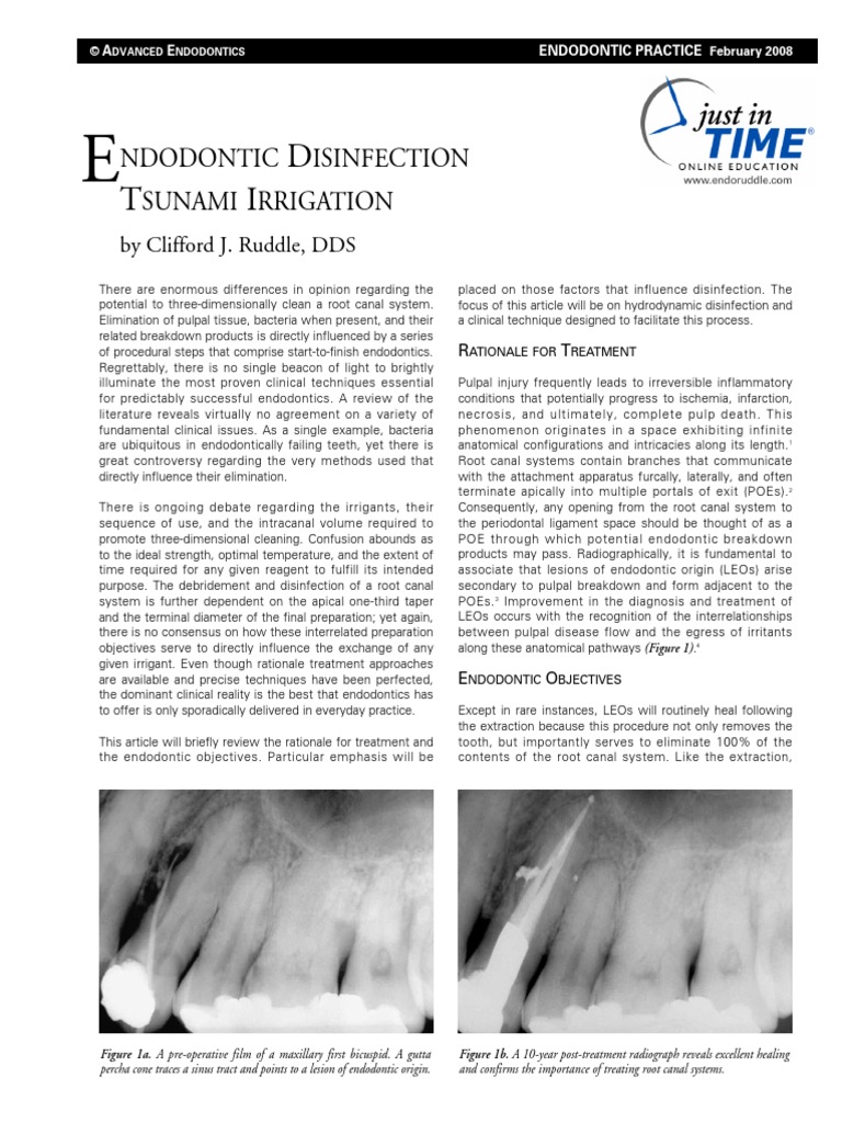 Ndodontic Isinfection Sunami Rrigation: by Clifford J. Ruddle, DDS ...