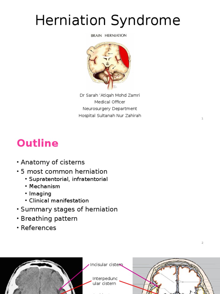 Brain Herniation Syndrome | Brain | Neuroanatomy