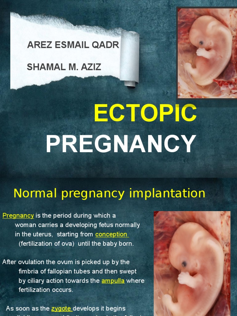 Ectopic Pregnancy1 | PDF | Uterus | Implantation (Human Embryo)