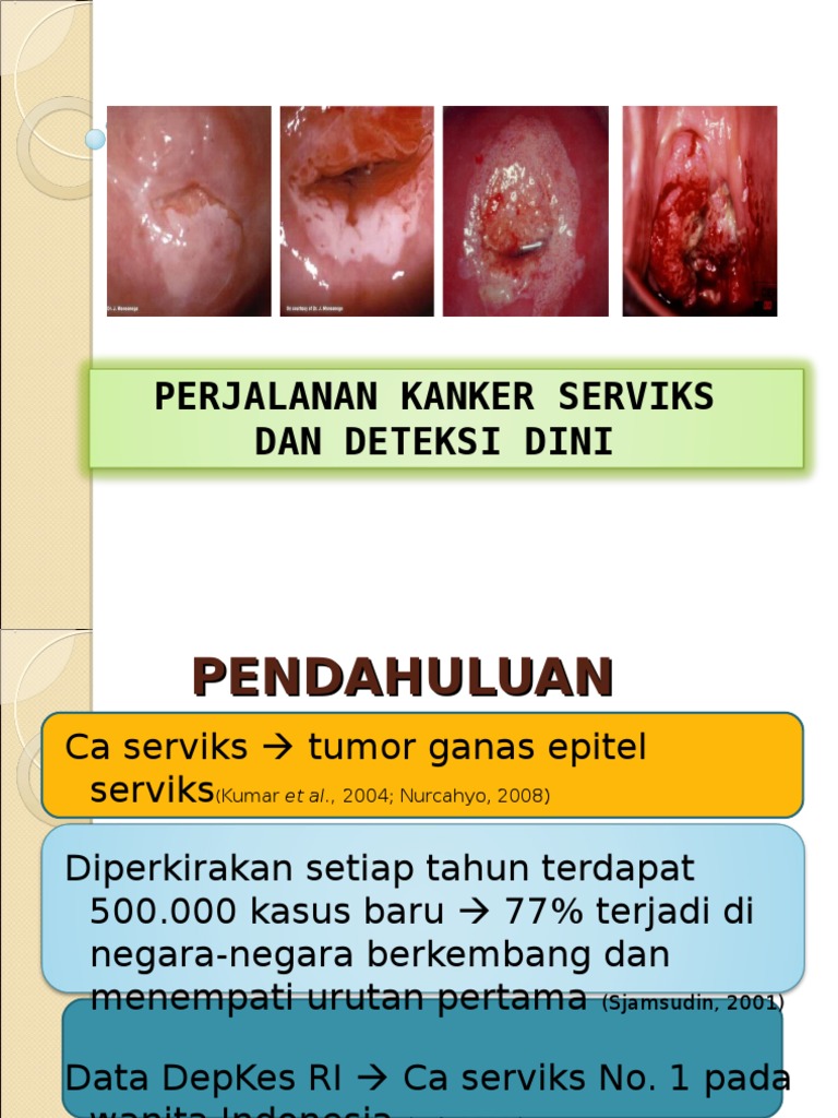 Perjalanan Kanker Leher Rahim | PDF