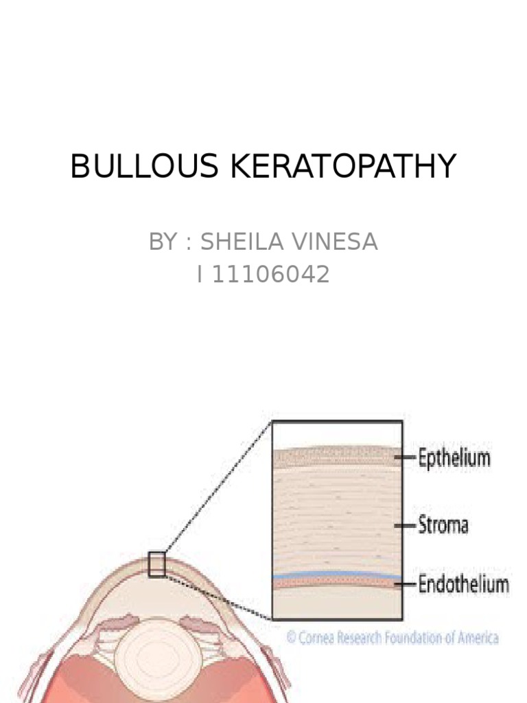 Understanding Bullous Keratopathy | PDF | Cornea | Ophthalmology