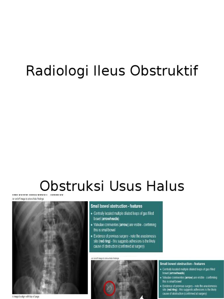 Radiologi Ileus Obstruktif | PDF