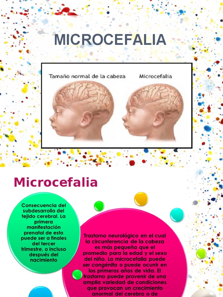 Microcefalia: Causas y Diagnóstico | PDF | Ciencias de la Salud | Medicina