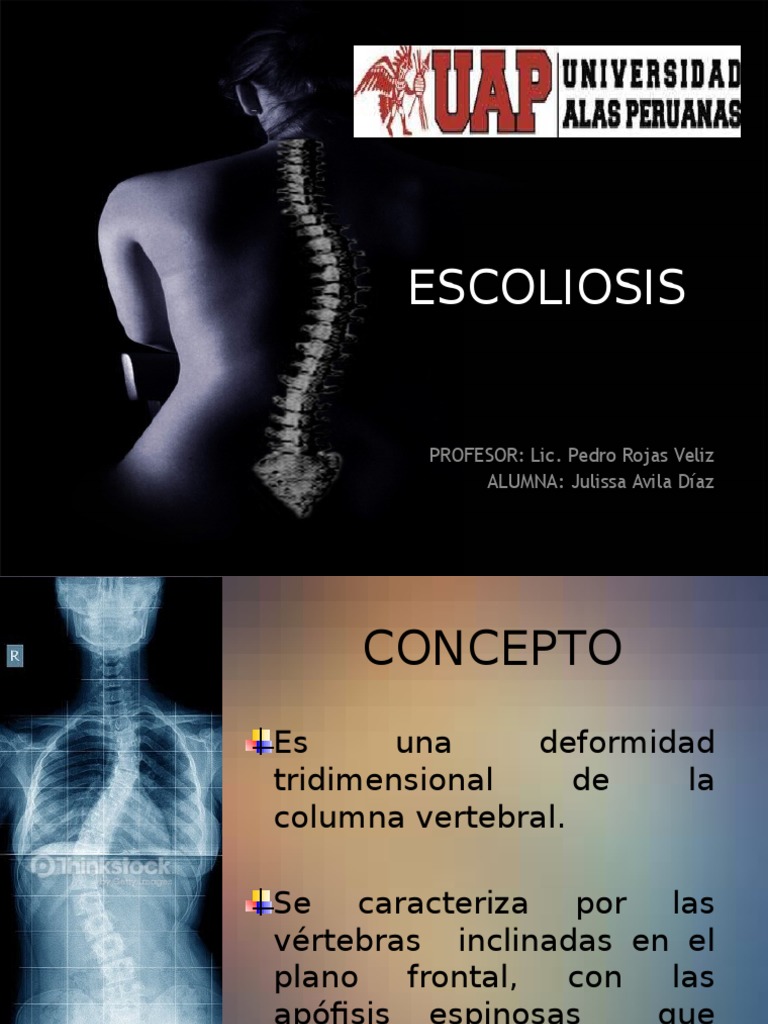 Escoliosis | Escoliosis | Vértebra | Prueba gratuita de 30 días | Scribd